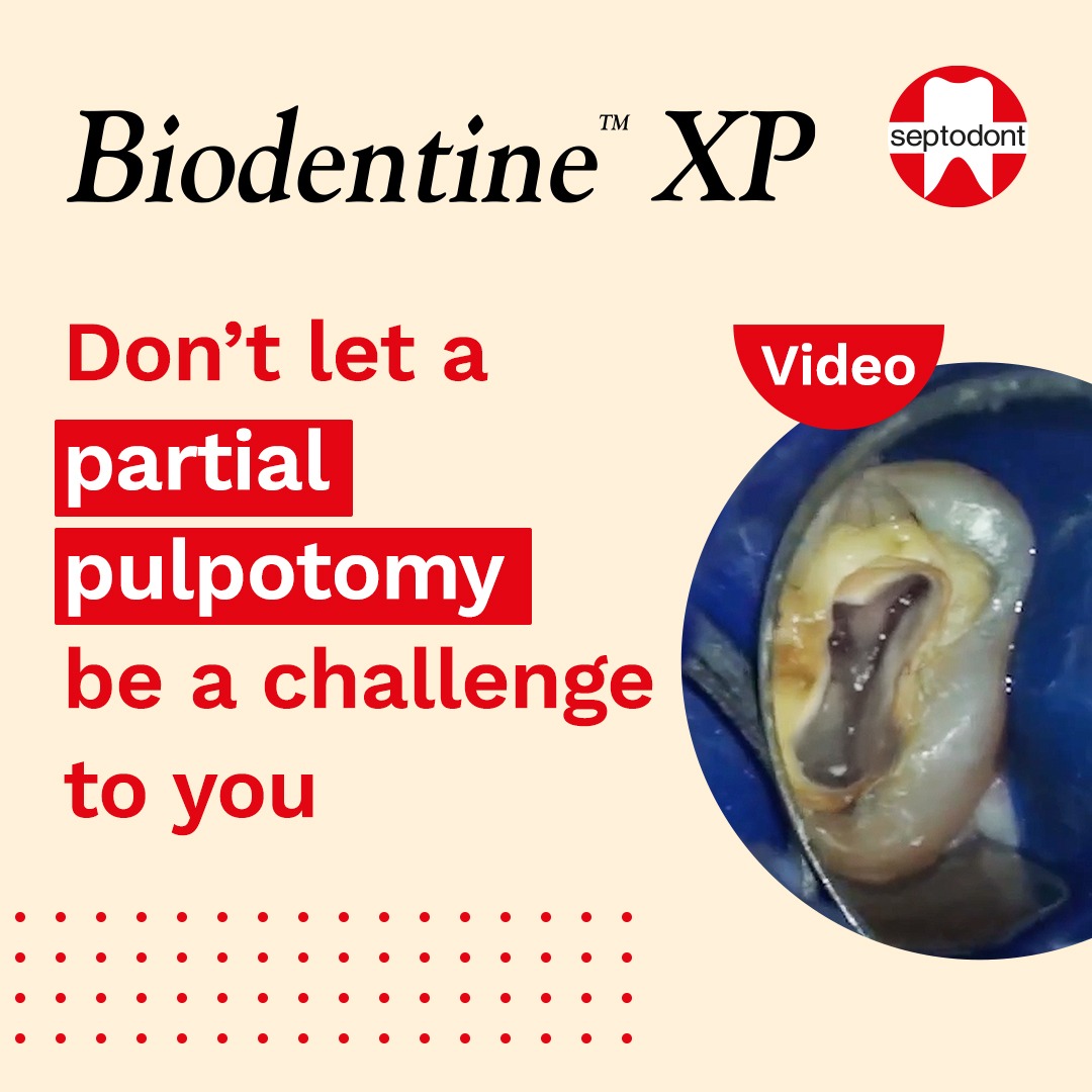 Dive into Dr. Lozano’s latest video clinical case of a pulpotomy on ...