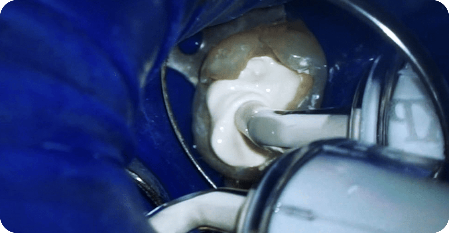 Explore Dr. Lozano's one-session pulpotomy case study using Biodentine ...
